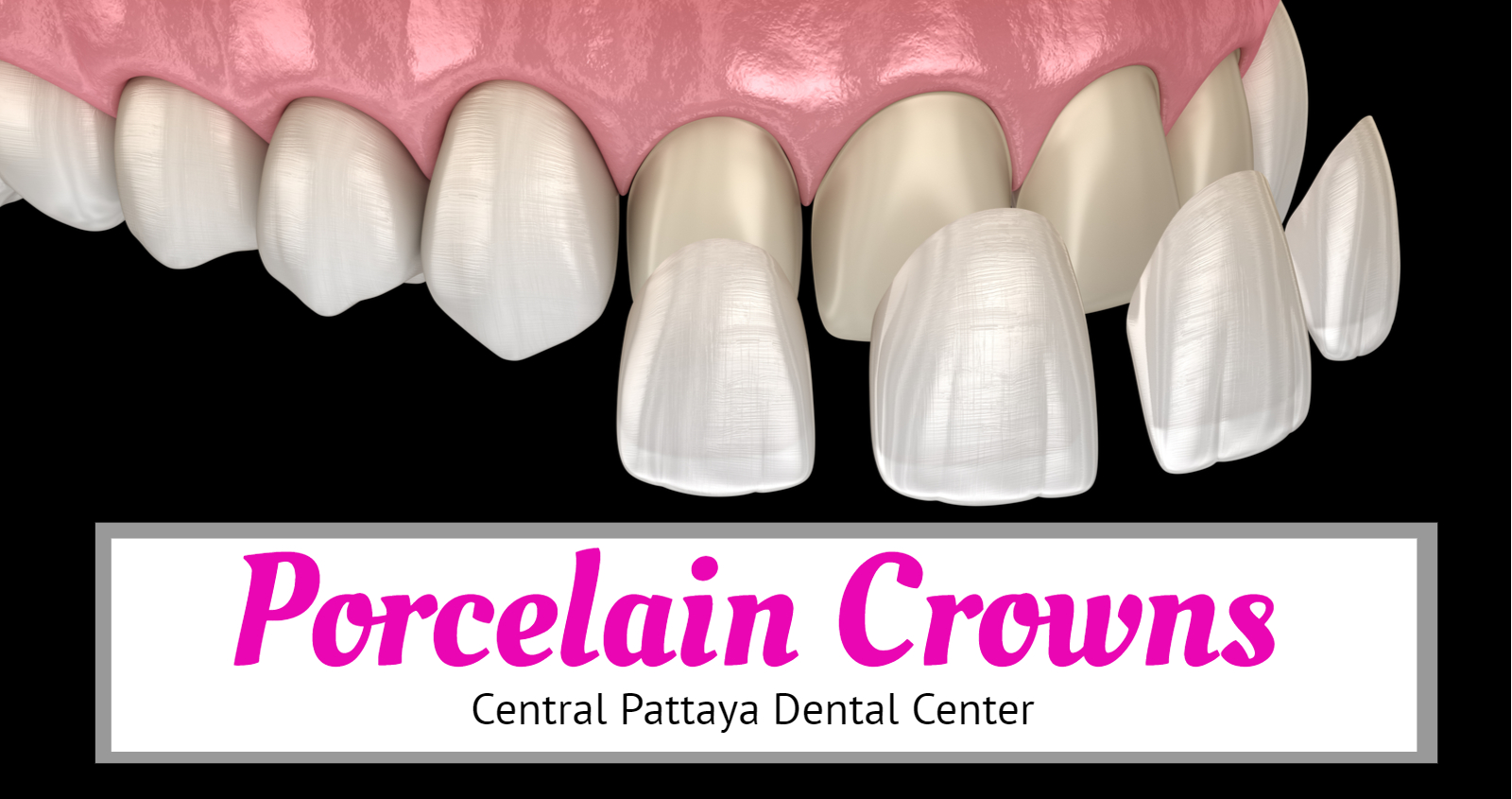 Porcelain Crown - Pattaya Dental Clinic, Dental Clinic Pattaya, Dentist ...
